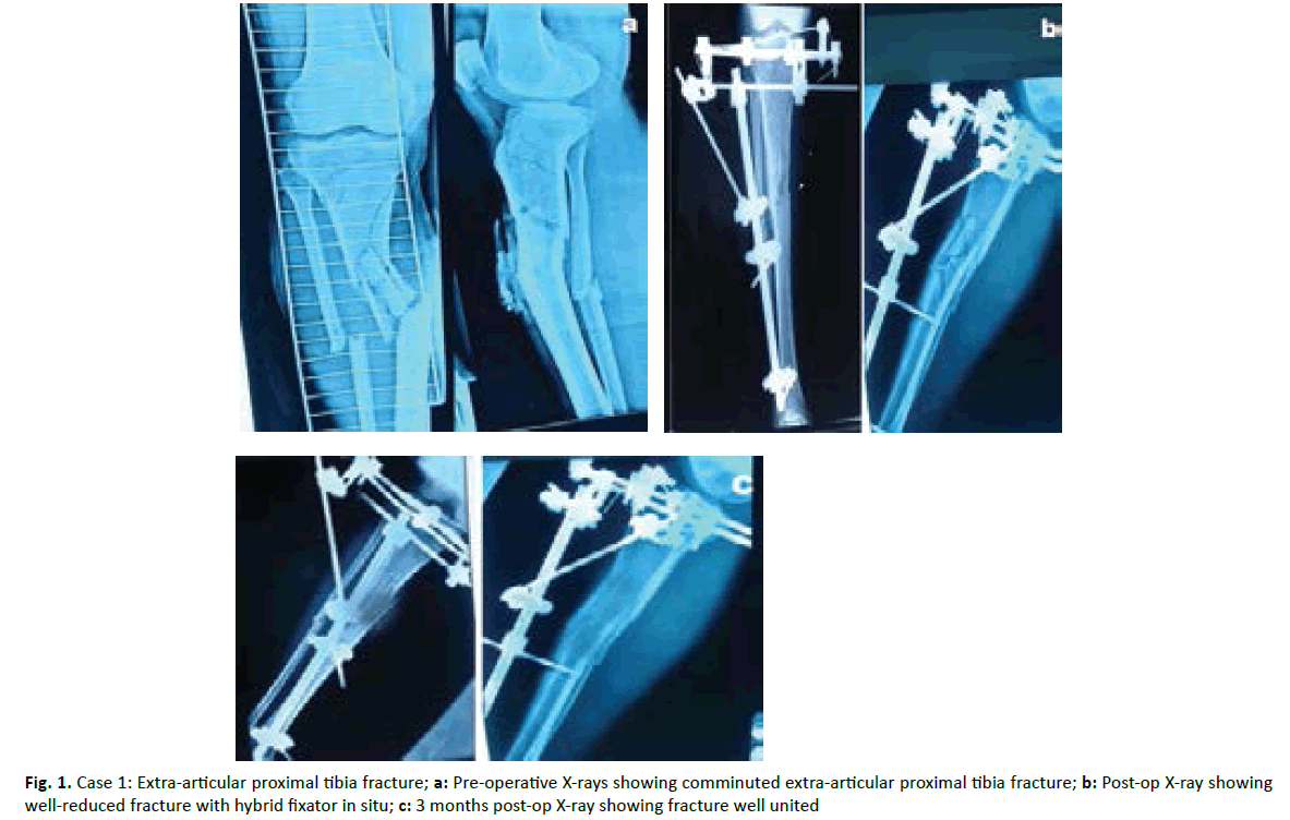 Hybrid External Fixator With Or Without Minimal Internal Fixation