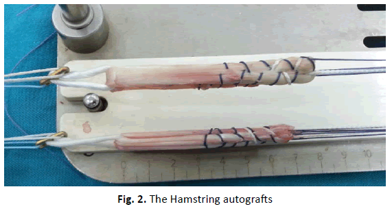 Arthroscopic double-bundle anterior cruciate ligament reconstruction ...