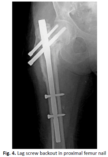 Evaluation of unstable trochanteric fractures treated with natural nail ...