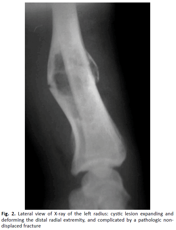 Pathologic fracture revealing solid aneurysmal bone cyst of the distal ...
