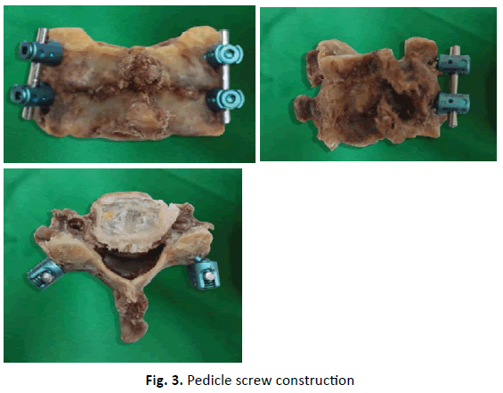 Comparison between short segment pedicle and lateral mass screw ...