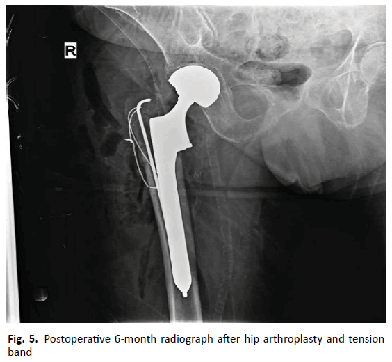 The clinical and functional results of trochanter major fixation in ...