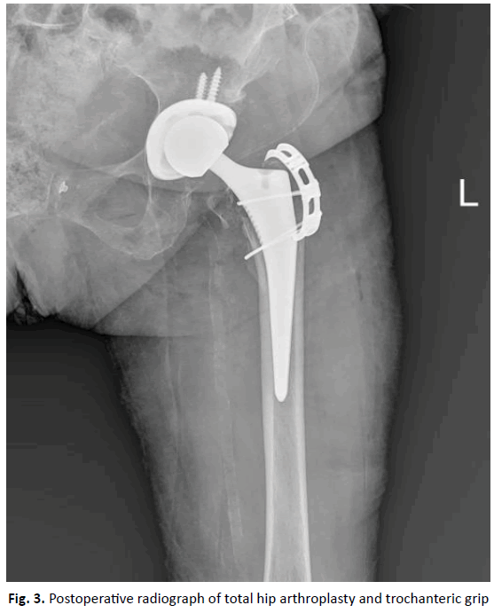 The clinical and functional results of trochanter major fixation in ...