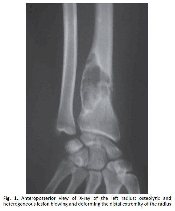 Pathologic fracture revealing solid aneurysmal bone cyst of the distal ...