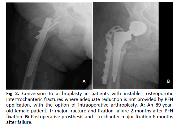 Treatment of intertrochanteric fractures with primary and secondary ...