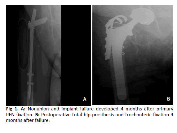 Treatment of intertrochanteric fractures with primary and secondary ...
